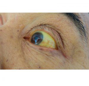 Jaundice – National Foundation For Digestive Diseases